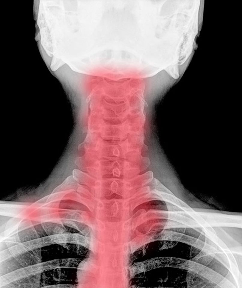 Spondiloza cervicala: cauza ametelilor si a furnicaturilor in brate