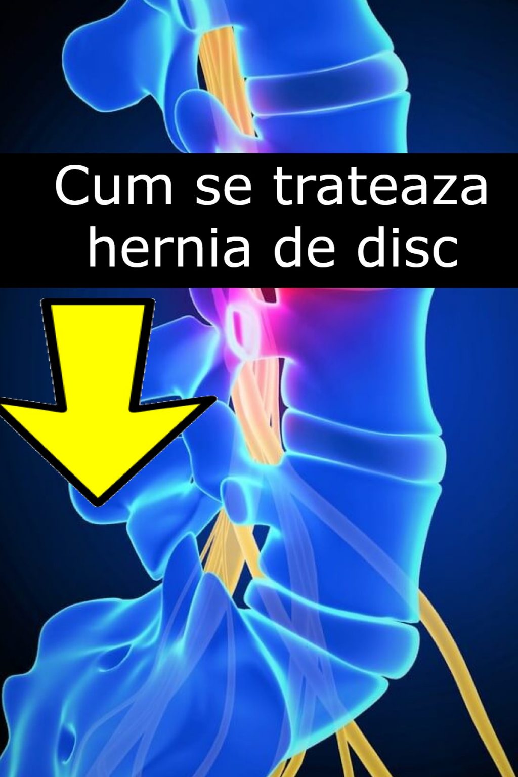 Hernia de disc se tratează în timp record: 20 de minute! Procedura ...